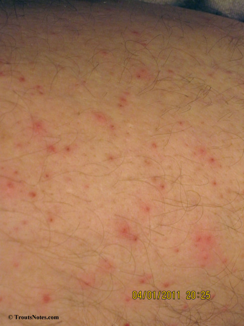 Ehrlichia-rash_IMG_5333 – Trout's Notes